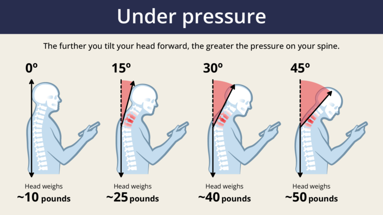 What is tech neck? | My Vanderbilt Health