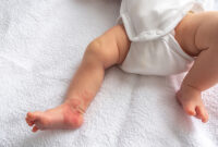 Decoding your baby’s birthmark | My Vanderbilt Health